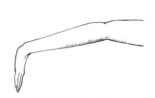 Hypermobility and PoTS - PoTS UK